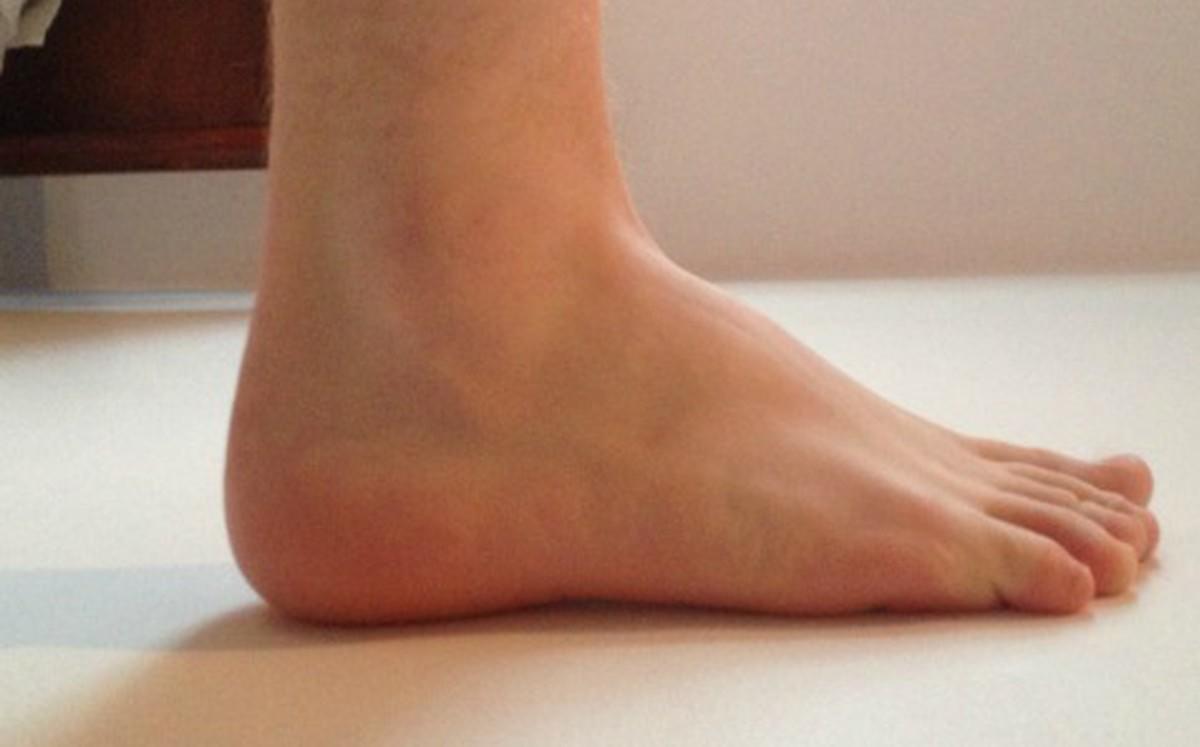 Por intenso dolor en el talón, descubren que hombre padecía cáncer de ...