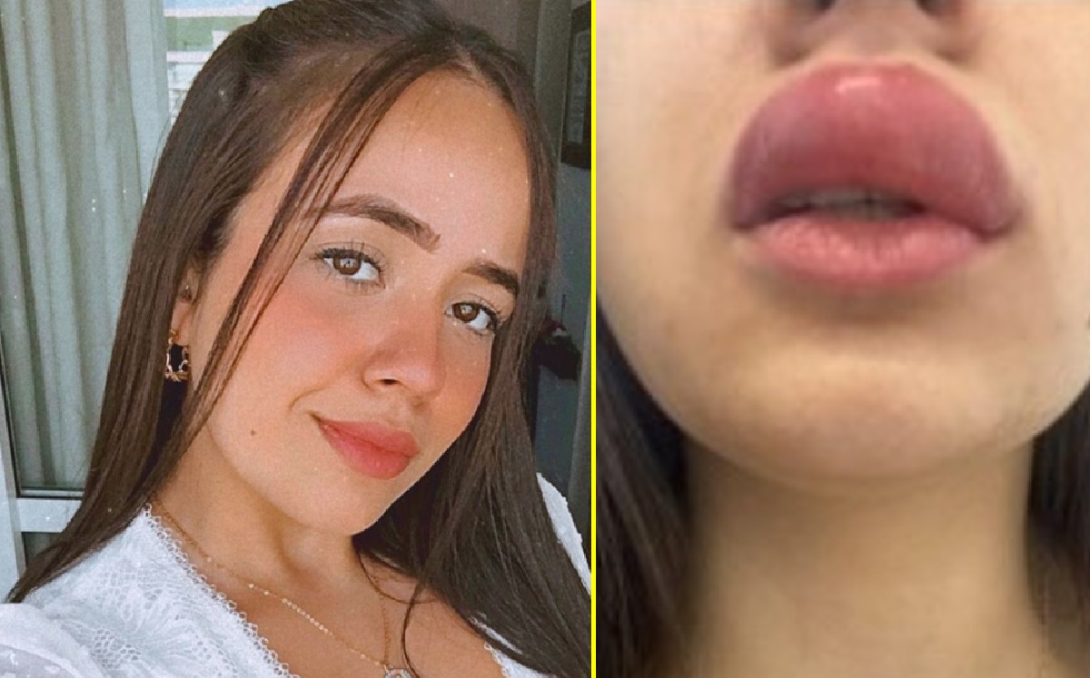 ¿Botox? Mujer despierta con los labios hinchados y se hace viral ...